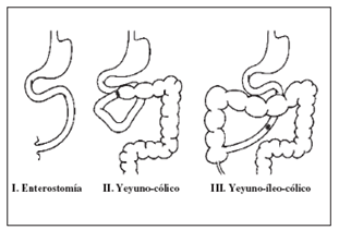 Segmento intestinal invertido (bucle intestinal antiperistáltico) en ...